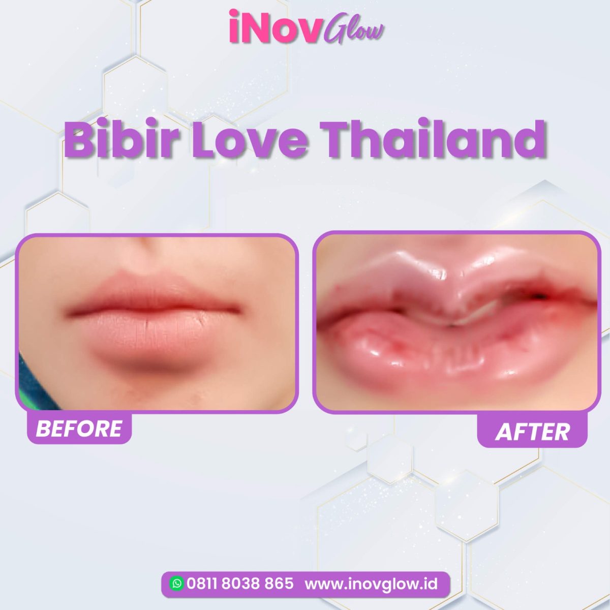 TAMPILKAN BIBIR SEKSI DENGAN OPERASI BIBIR LOVE THAILAND DI KLINIK ...