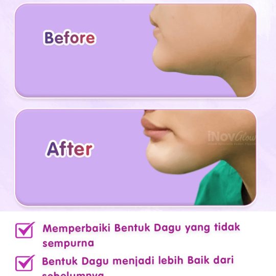 BEFORE AFTER OPERASI DAGU V-SHAPE - INOVGLOW - KLINIK SPESIALIS BEDAH ...