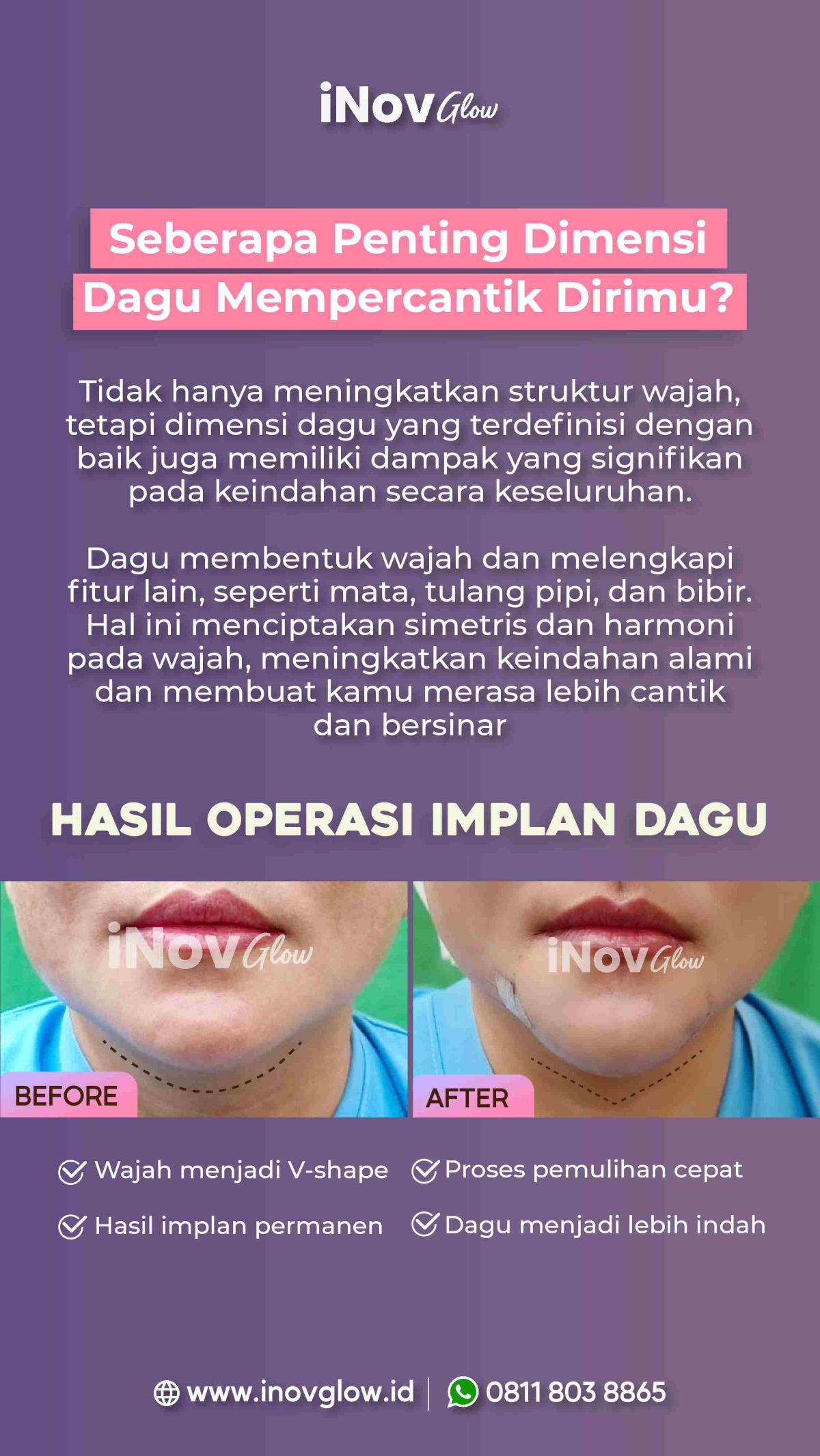 Operasi Dagu Terbaik di Jakarta - iNOV GLOW