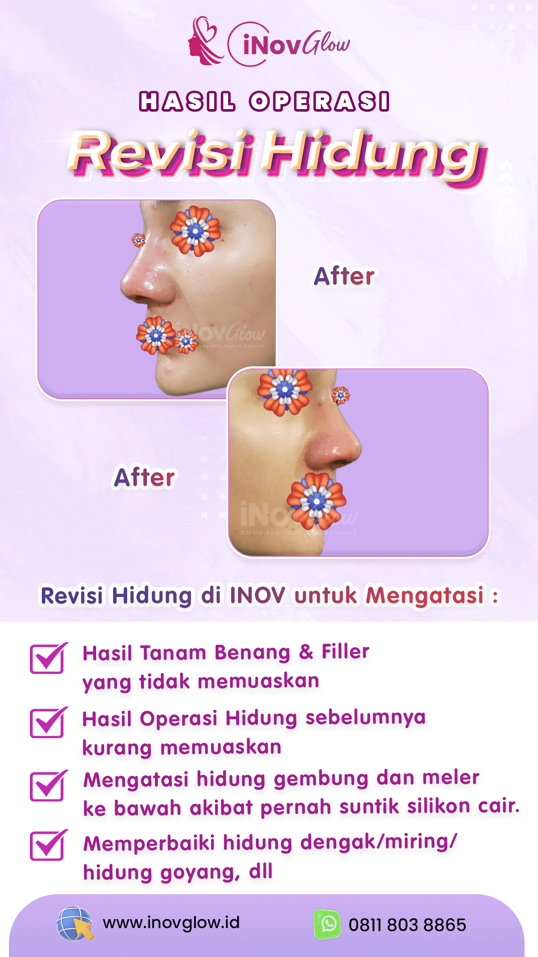 Panduan Revisi Hidung di Klinik Inov Glow - iNOV GLOW