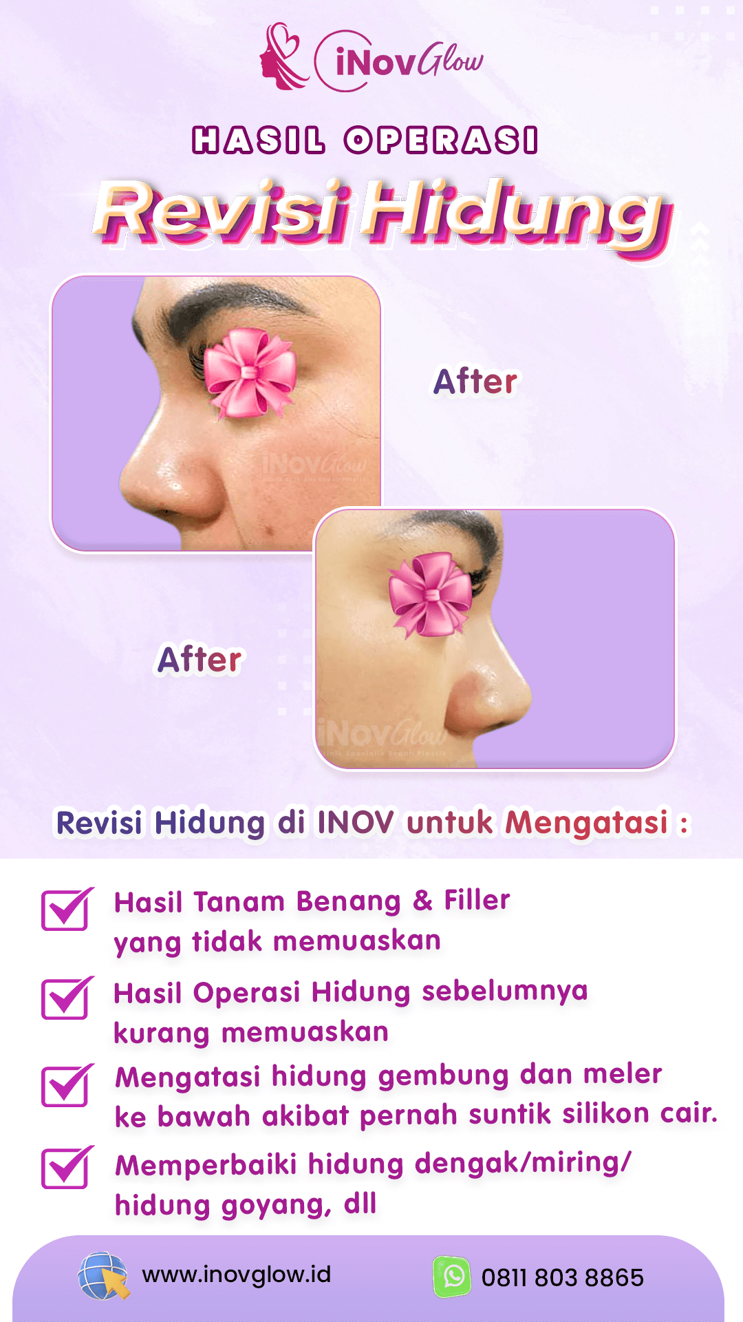 Mengenal Lebih Dekat Revisi Operasi Hidung di Klinik Inov Glow - iNOV GLOW