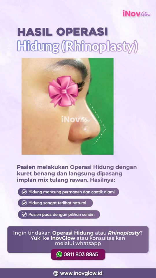 Operasi hidung tulang rawan Archives - iNOV GLOW