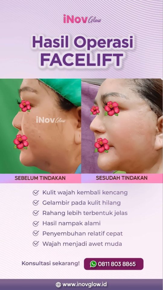 Operasi Facelift Rahasia Tampil Awet Muda - iNOV GLOW