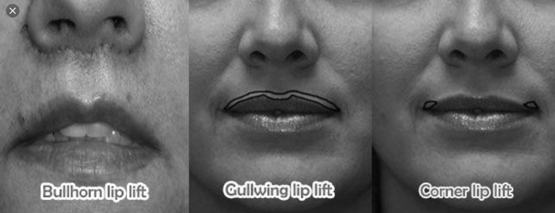 MEMAHAMI TENTANG PROSEDUR LIP LIFT - iNOV GLOW