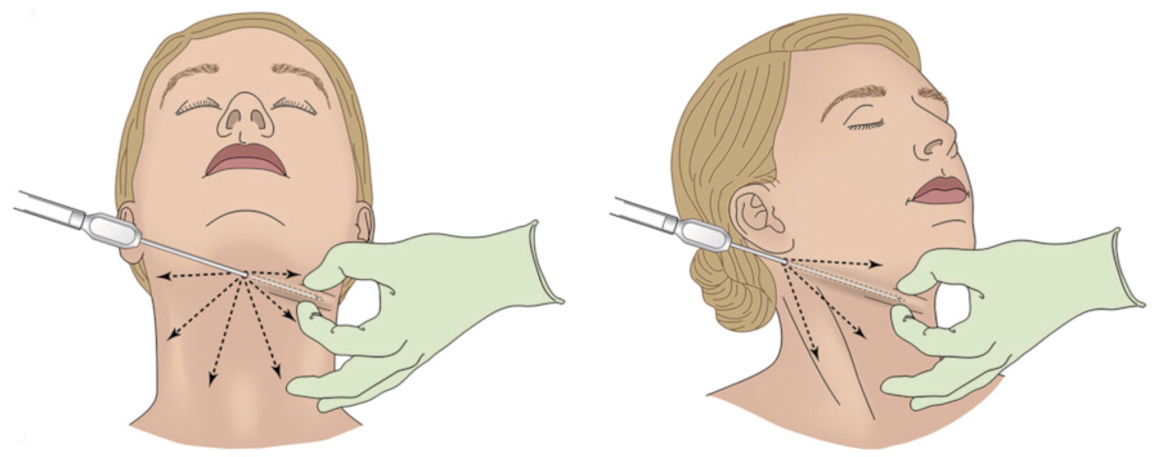 Perbedaan Sliding Genioplasty dan Implan Dagu (Part 2) - iNOV GLOW