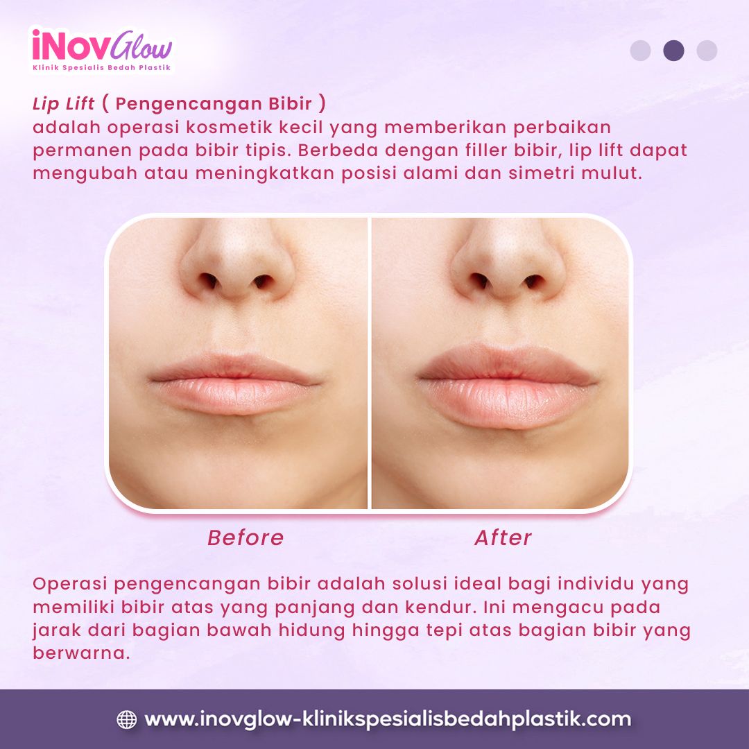 AUGMENTASI BIBIR VS LIP LIFT. APA BEDANYA ? - iNOV GLOW