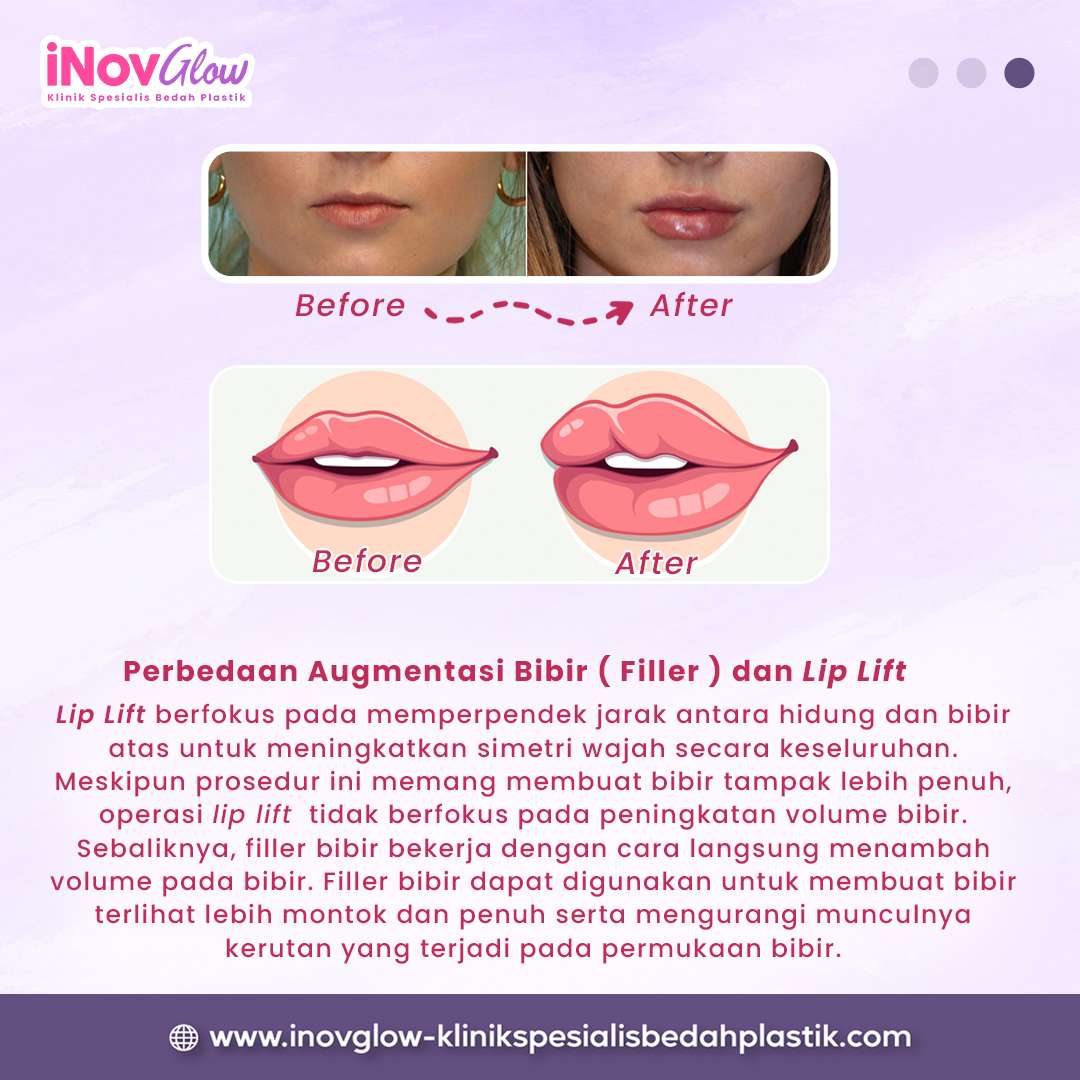 AUGMENTASI BIBIR VS LIP LIFT. APA BEDANYA ? - iNOV GLOW