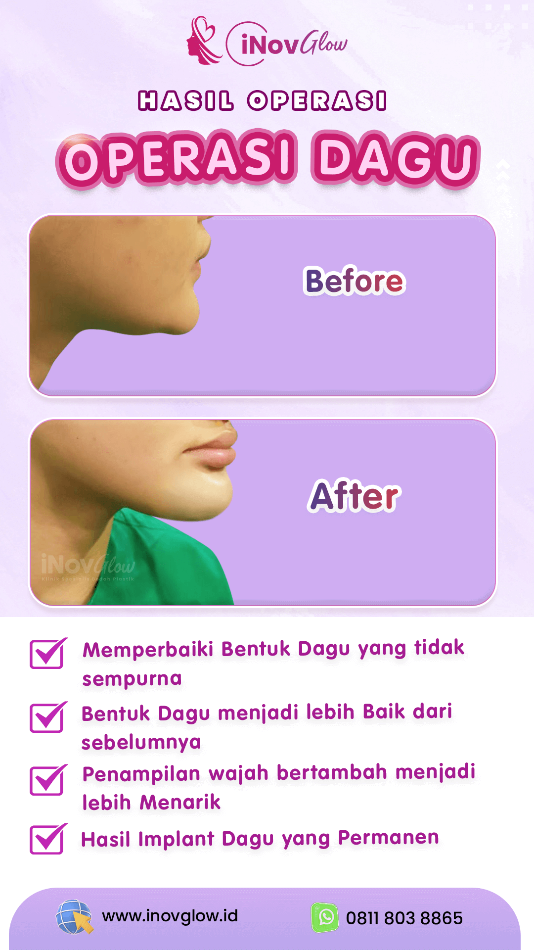 OPERASI IMPLAN DAGU DAN PROSES PEMULIHANNYA - iNOV GLOW