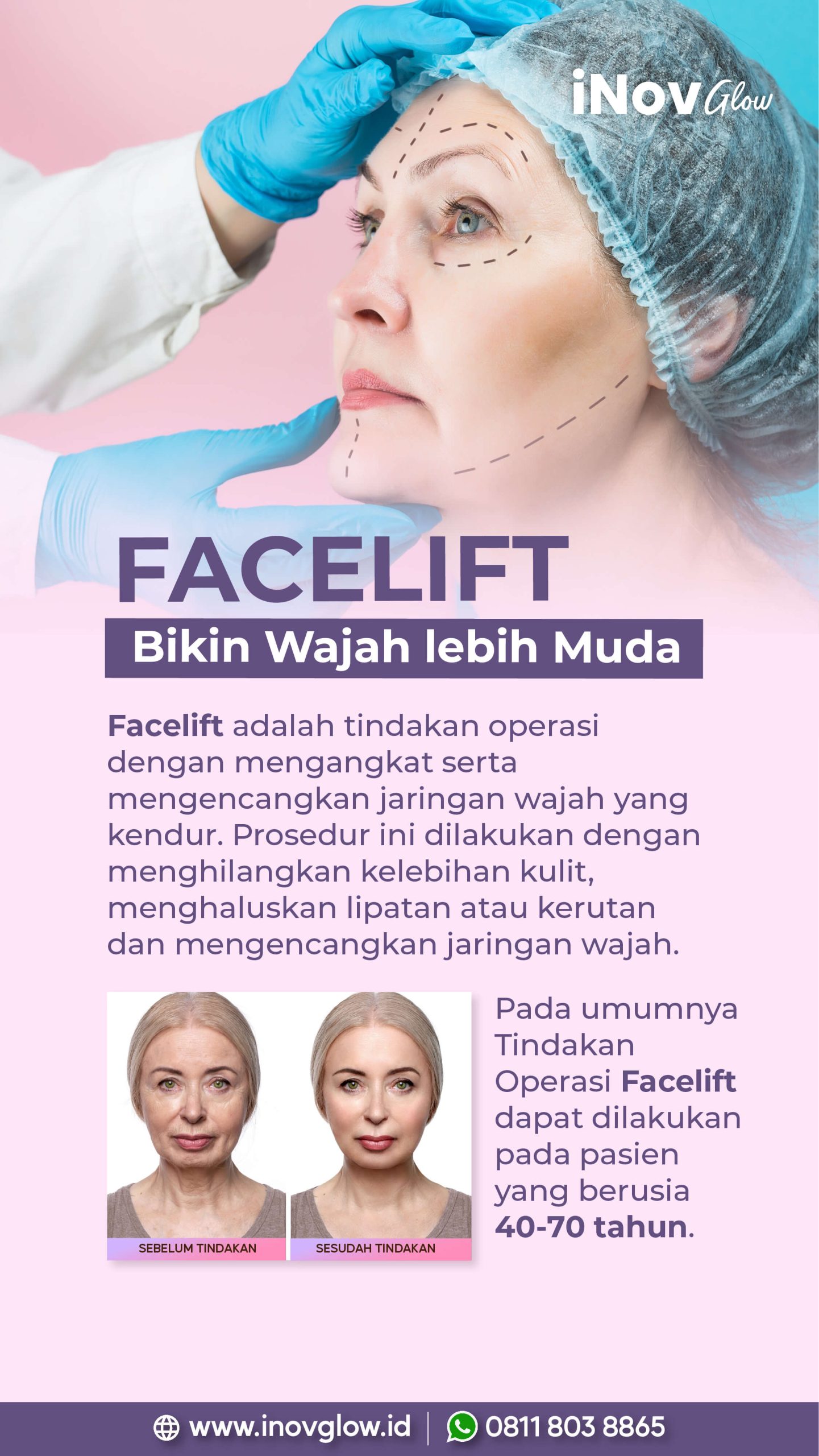 Apa yang Terjadi Setelah Facelift? Kenali Komplikasi dan Solusinya ...