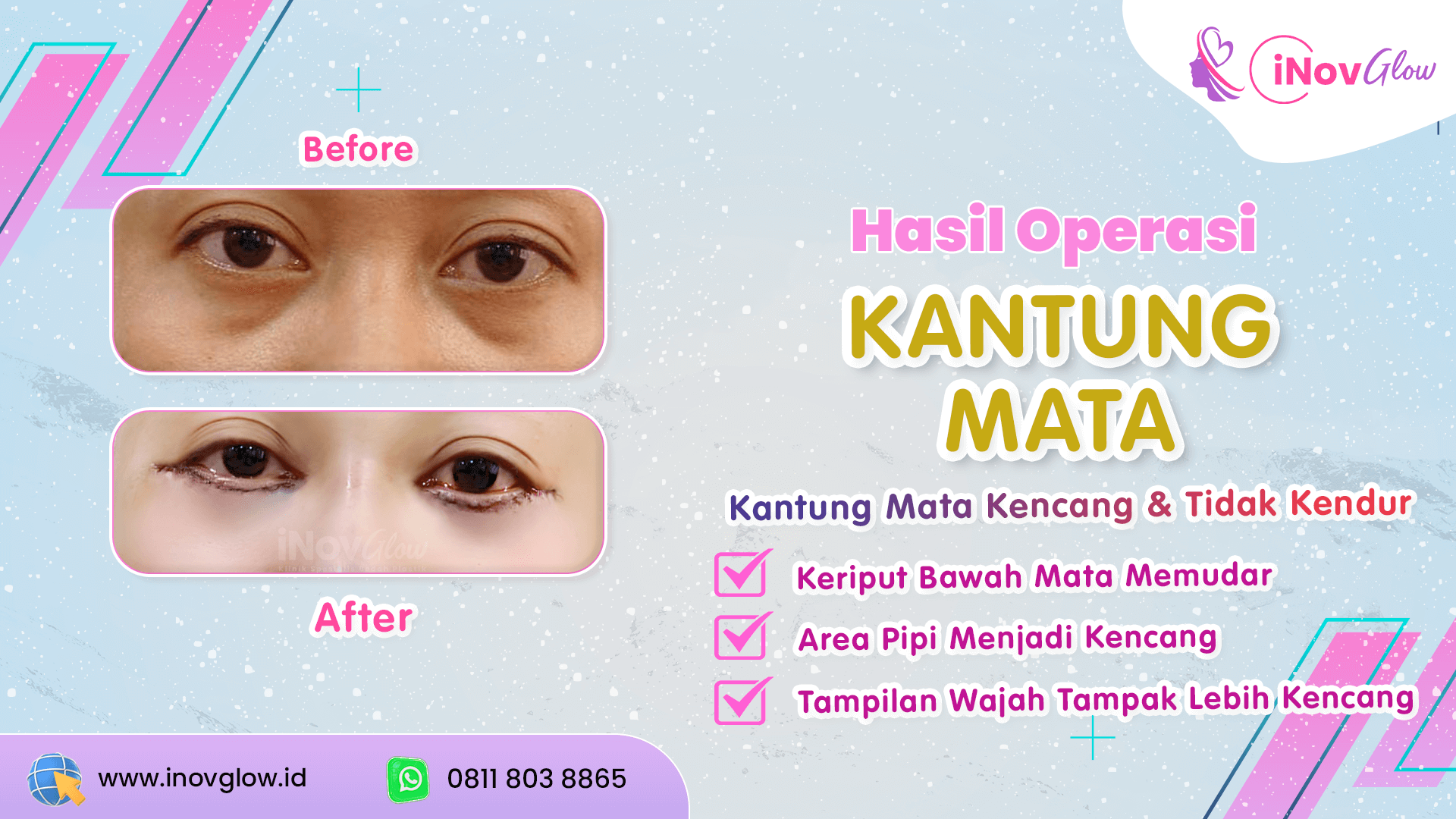 Operasi Kantung Mata Terbaik di Jakarta di Klinik Inov Glow - iNOV GLOW