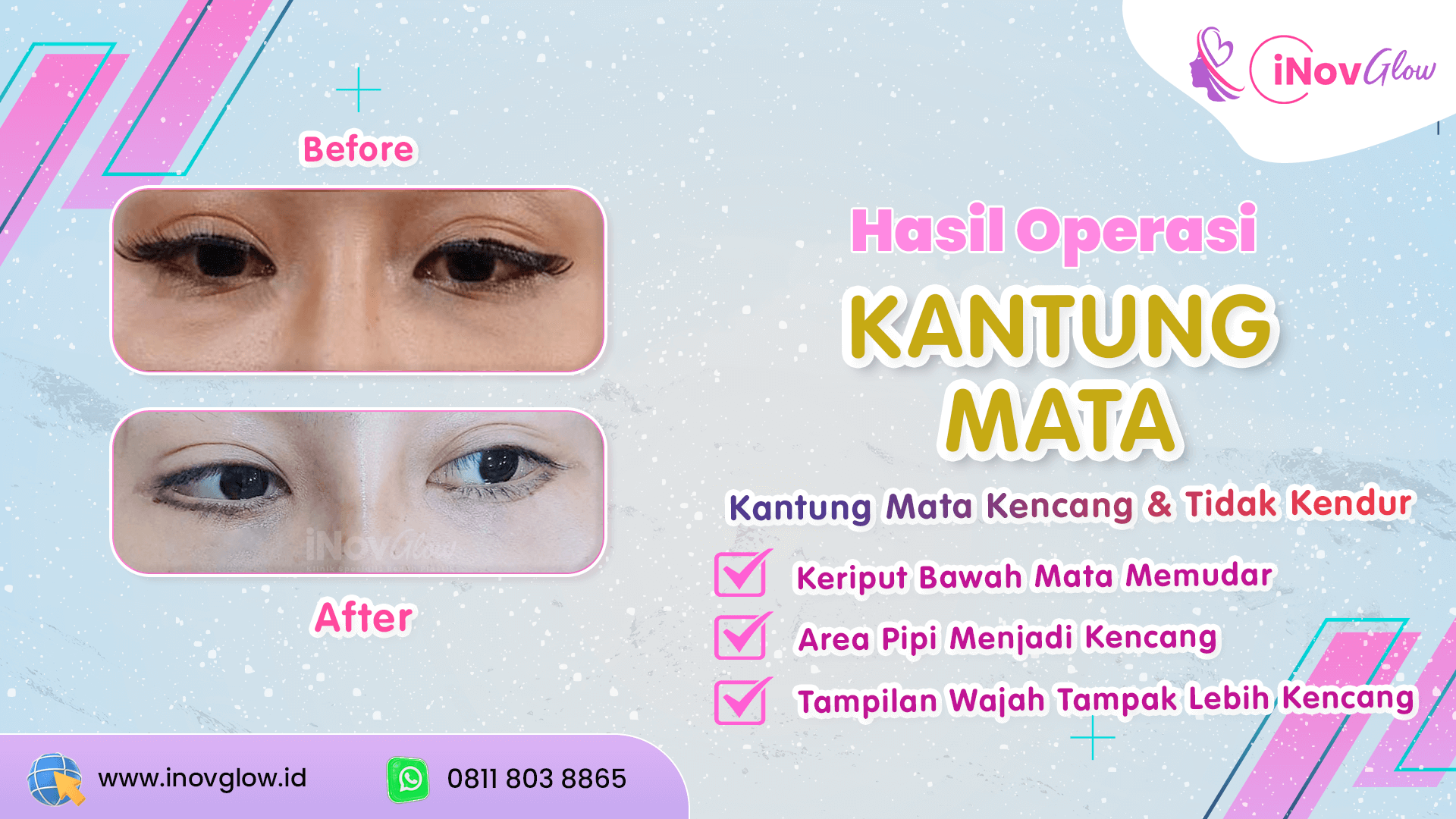Mengenal Blepharoplasty, Operasi Kelopak Mata Inov Glow - iNOV GLOW