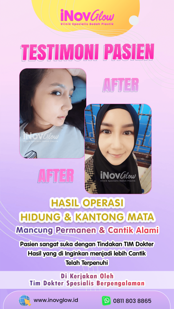 Operasi Hidung Gagal Solusi dengan Revisi Hidung di Klinik Inov Glow ...