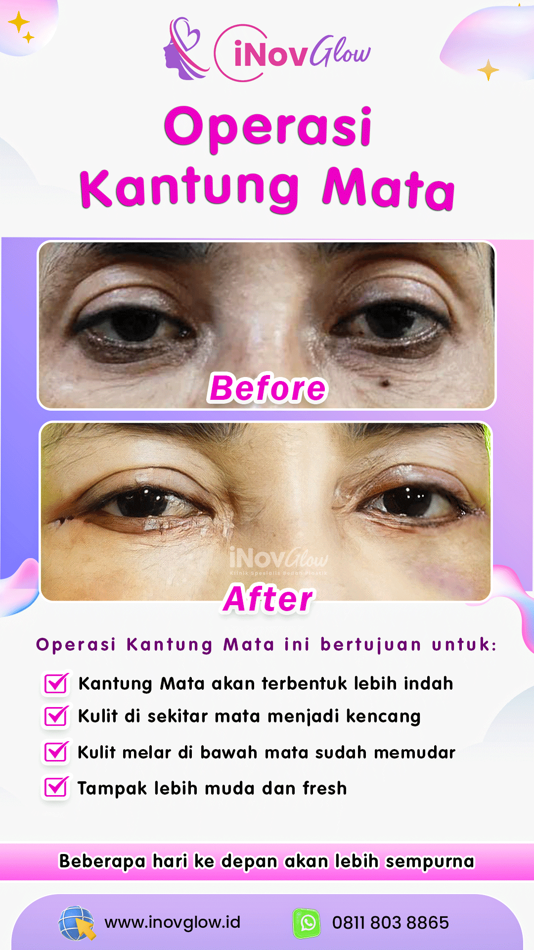 Operasi Kelopak Mata atau Blepharoplasty Atasi Mata Turun Dan Terkulai ...