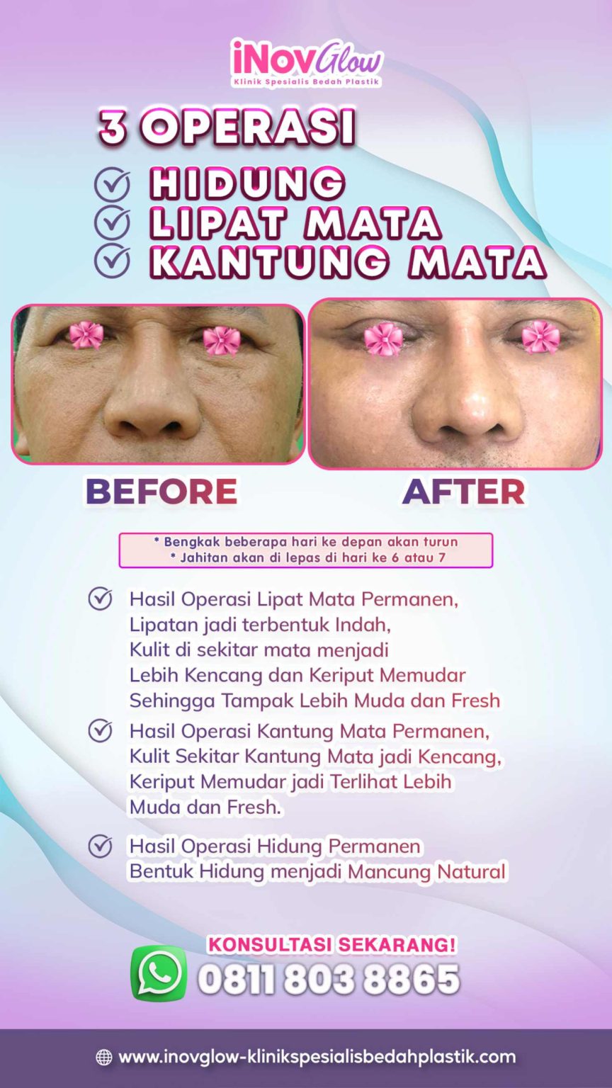 Mengenal Blepharoplasty, Operasi Kelopak Mata di Klinik Inov Glow ...