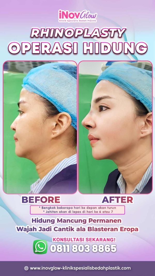 Bentuk Hidung mu! Kenali Jenis Bentuknya - iNOV GLOW